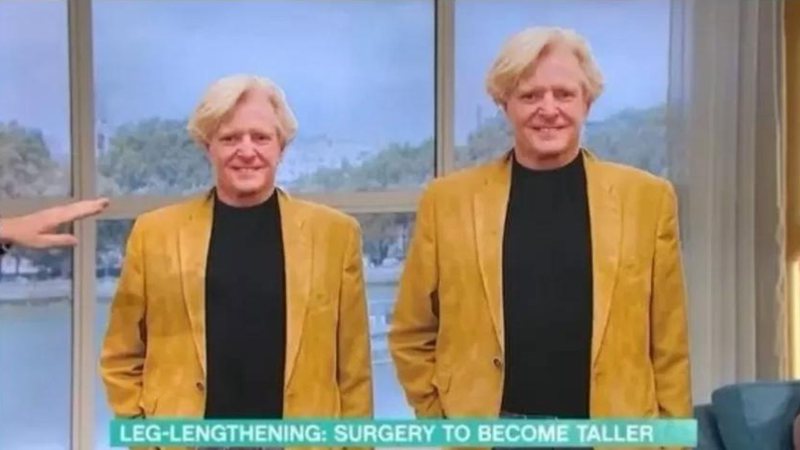 Homem gasta R$ 800 mil com procedimento para ficar mais alto | Enfoco ...